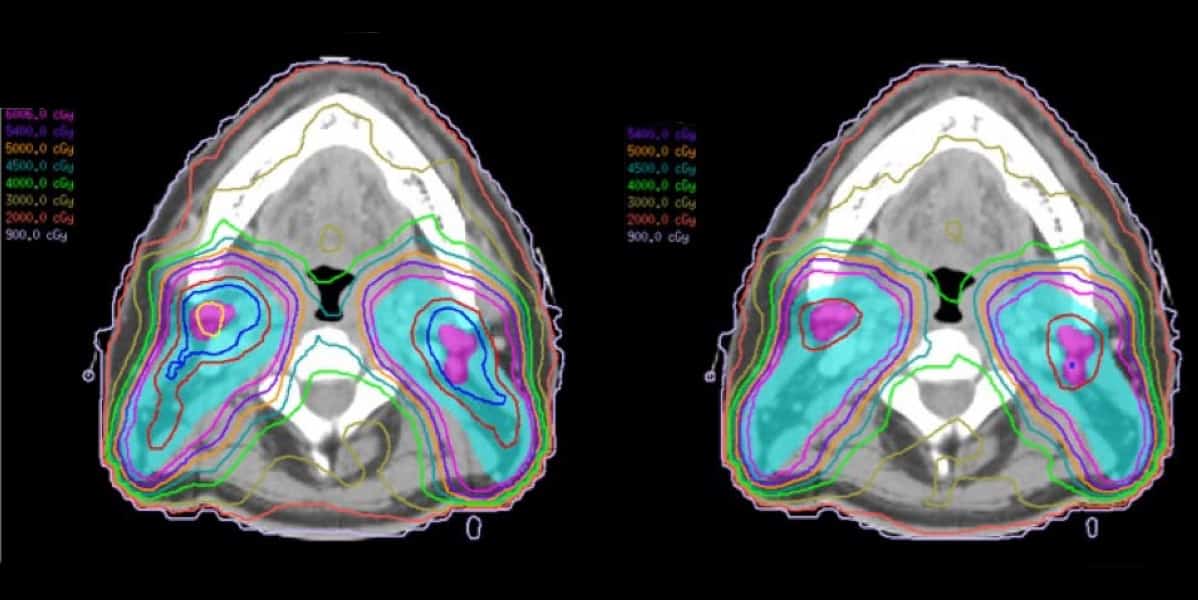 Optimizing MLC leaf speed could improve radiotherapy plan quality ...