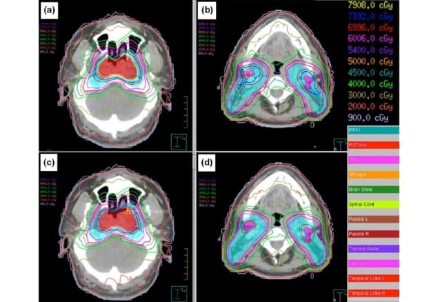 Optimizing MLC leaf speed could improve radiotherapy plan quality ...
