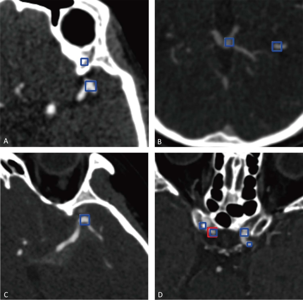 Deep Learning Based Algorithm Helps Radiologists Detect Cerebral
