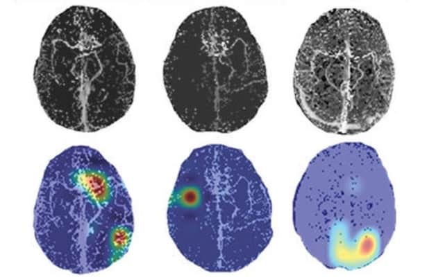 Deep Learning Based Algorithm Helps Radiologists Detect Cerebral