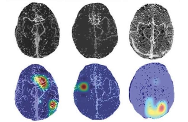 Deep-learning-based algorithm helps radiologists detect cerebral aneurysms – Physics World