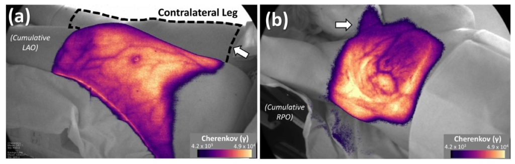Visualizing the treatment beam improves radiation therapy delivery ...