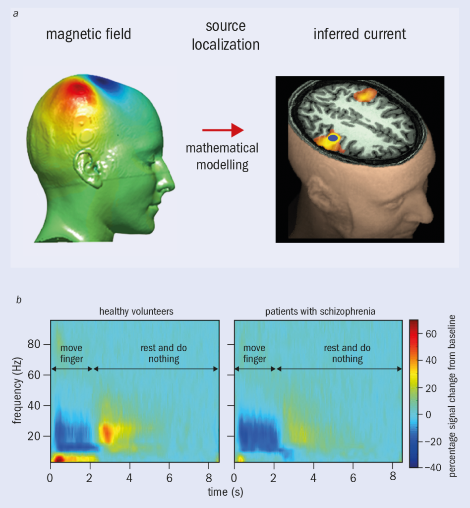 Quantum physics gives brain-sensing MEG scanners a boost – Physics World