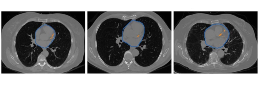 Open-source algorithm predicts heart attack risk from chest CT scan ...