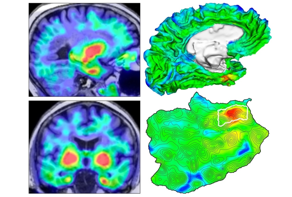 Novel PET tracer sheds light on plaque formation in Alzheimer's disease ...