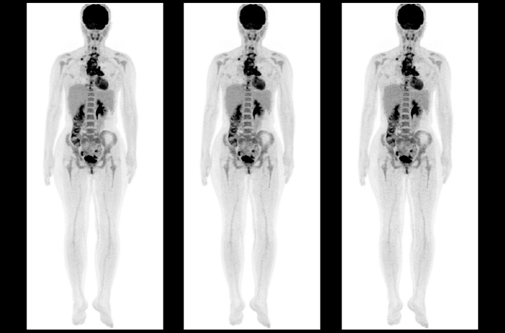 Ultrafast low-dose PET scans will benefit cancer patients – Physics World