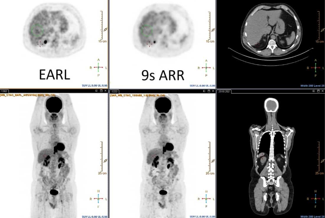 PET scan Conchita Giron PET scan Conchita Giron