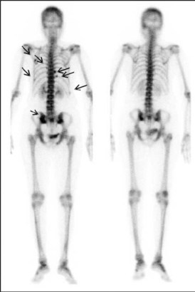 Celebrating a century of nuclear isomers – Physics World