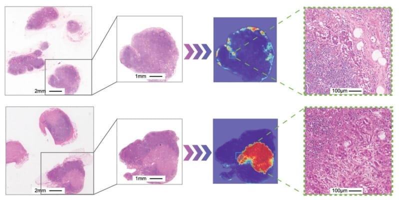 Deep learning helps doctors predict gastric cancer metastasis – Physics ...