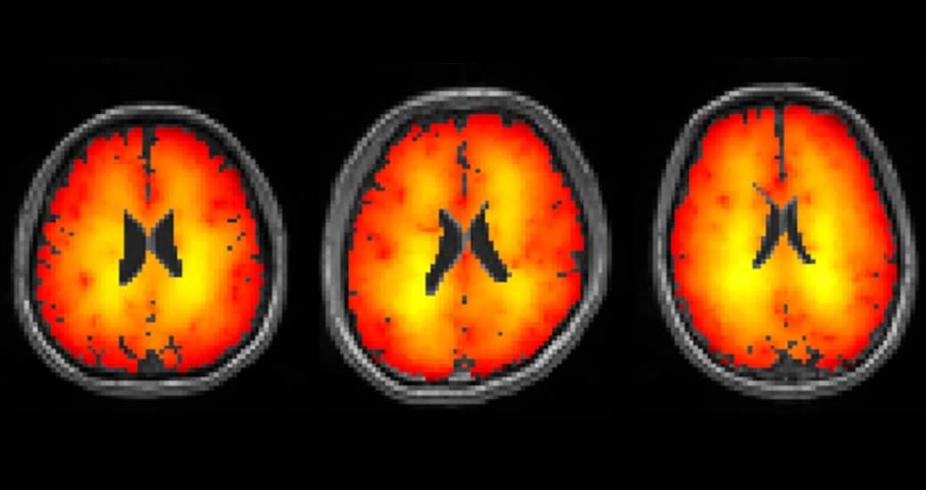 Personalized brain temperature maps created using MRI and biophysical ...