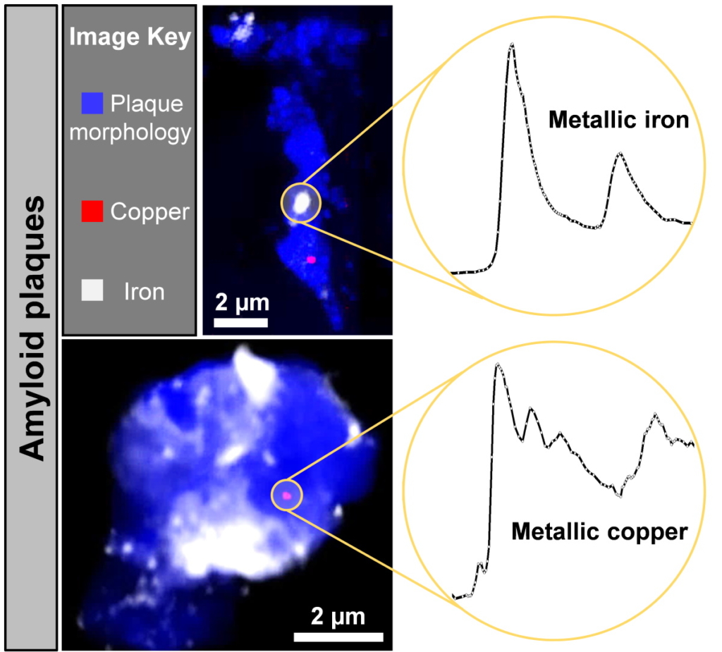 Elemental forms of metals discovered in brains of Alzheimer’s patients ...
