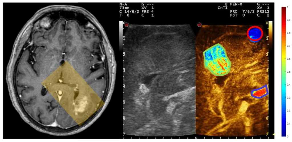 Mapping microbubble distribution in the brain – Physics World