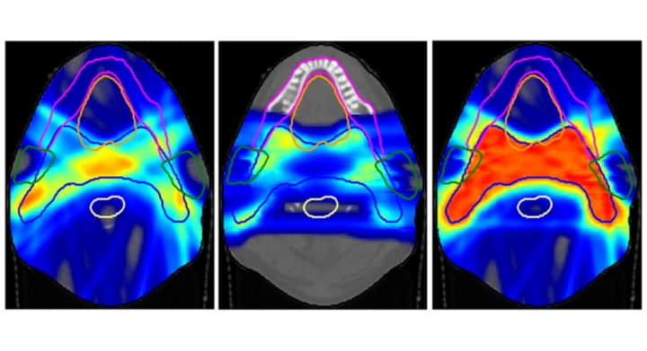Particle therapy Archives – Physics World