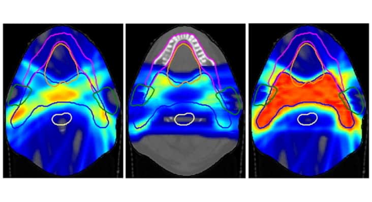 Particle therapy Archives – Physics World