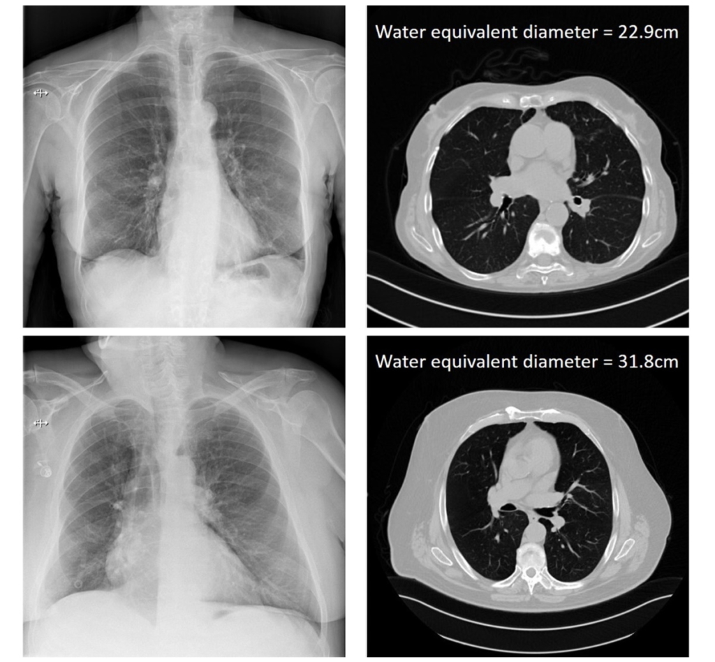 Estimating patient size from X-ray data improves radiation risk ...