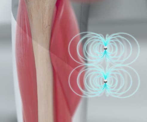 Magnetic beads inside the body could improve control of bionic limbs ...