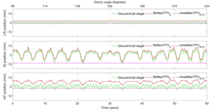X-ray guidance keeps cardiac radioablation on target – Physics World