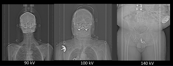 CT imaging in radiotherapy: standardization and personalization are the ...