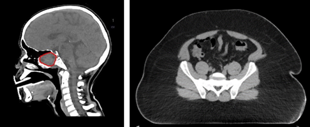 CT imaging in radiotherapy: standardization and personalization are the ...