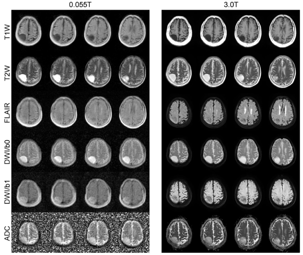 Ultralow Field Mri Scanner Could Improve Global Access To Neuroimaging