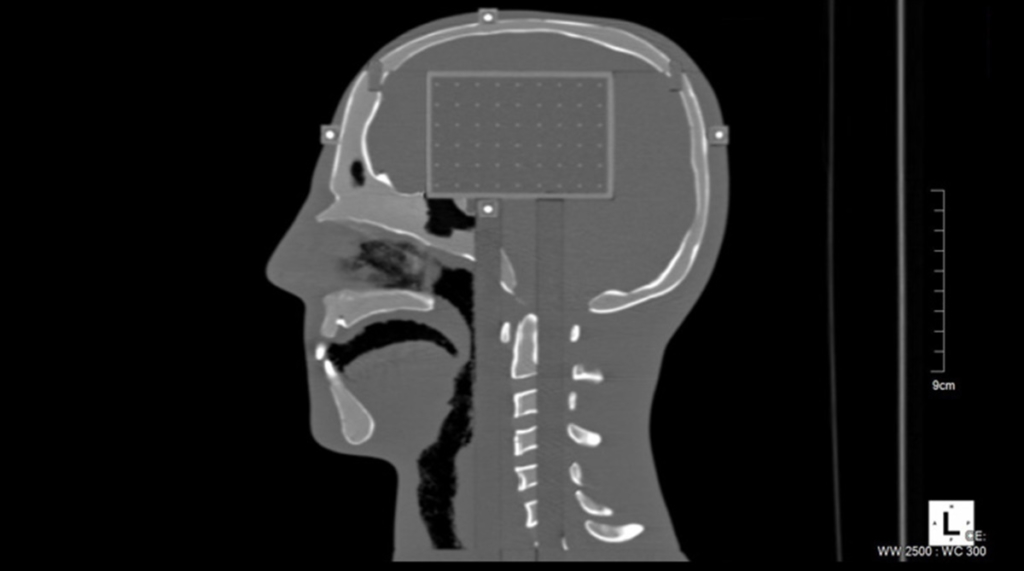 Anthropomorphic STEEV phantom underpins independent auditing of SRS ...