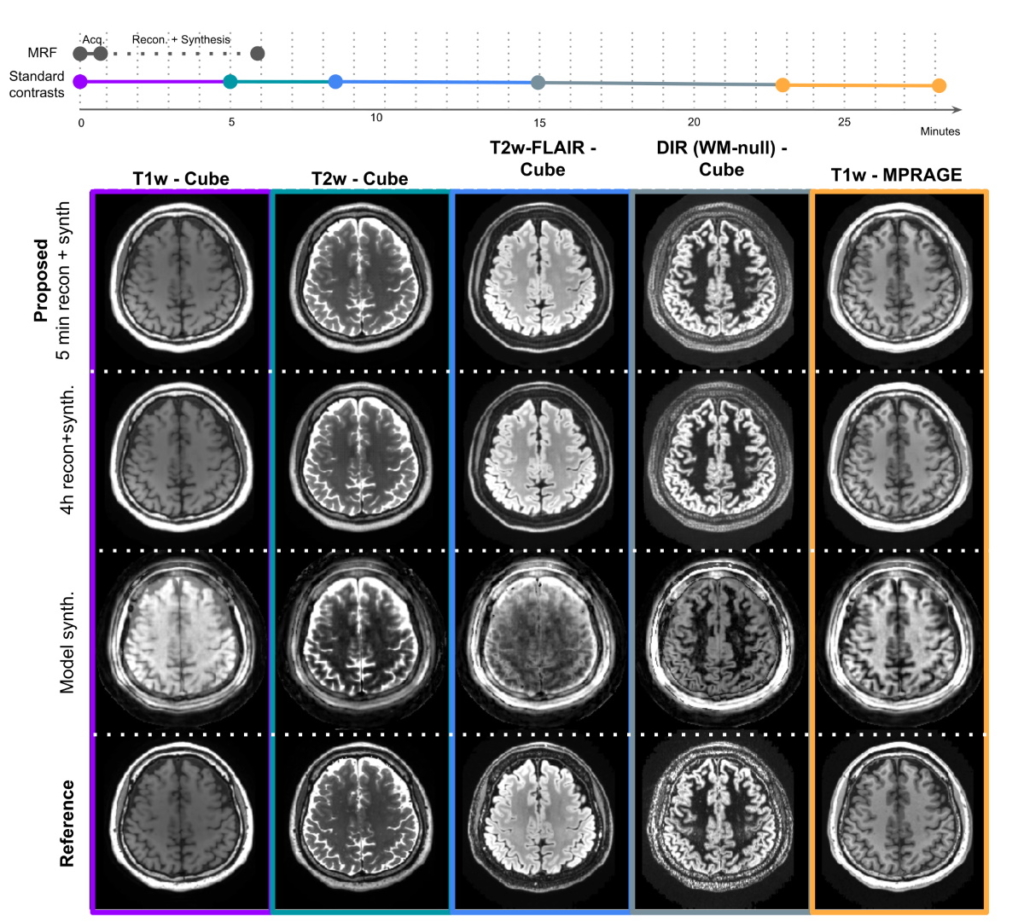 Can machine learning deliver one-minute brain MRI scans? – Physics World