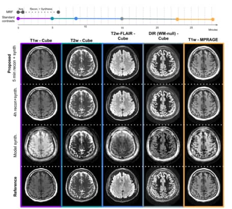 Can machine learning deliver one-minute brain MRI scans? – Physics World