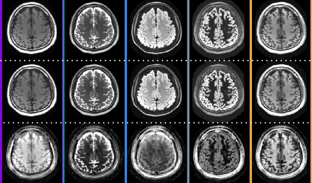 Can machine learning deliver one-minute brain MRI scans? – Physics World