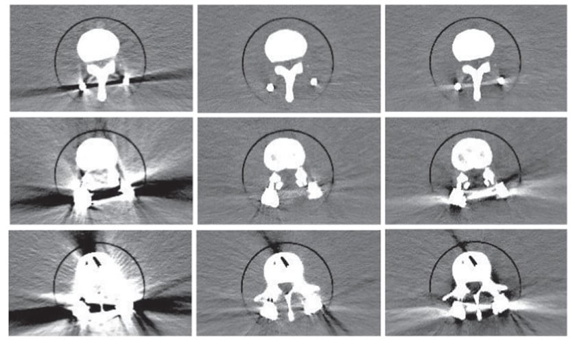 Reducing metal artefacts in photon-counting CT – Physics World