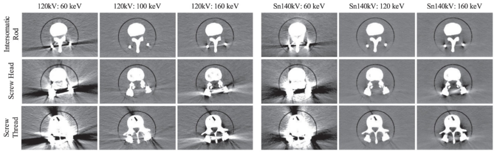 Reducing metal artefacts in photon-counting CT – Physics World