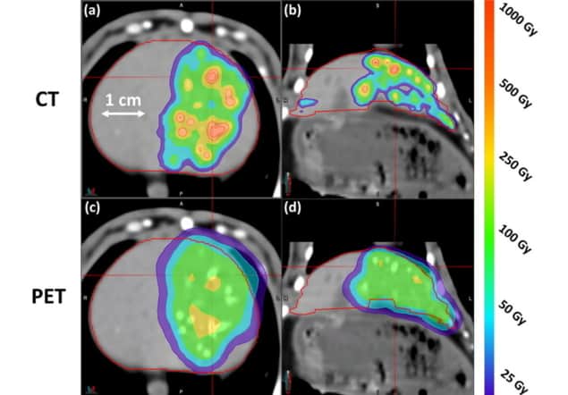 CT imaging improves 90Y radioembolization dosimetry – Physics World