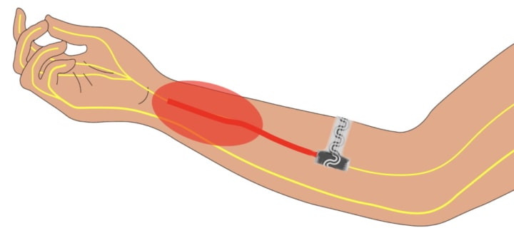Dissolvable implant cools nerves to provide drug-free pain relief ...