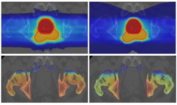 Particle therapy Archives – Physics World
