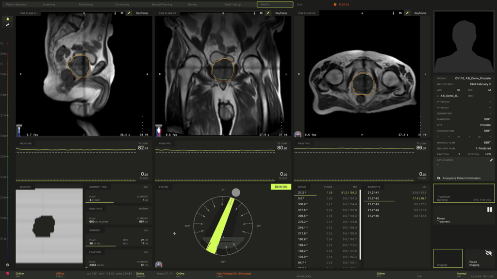 Parallel workflows, multiplanar tracking: ViewRay takes MRgRT to the ...