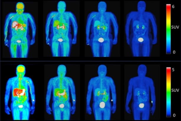 Nuclear medicine Archives – Physics World