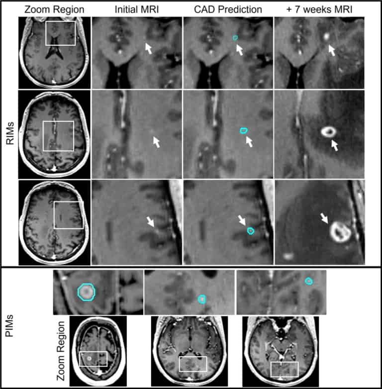 Deep-learning system identifies difficult-to-detect brain metastases – Physics World
