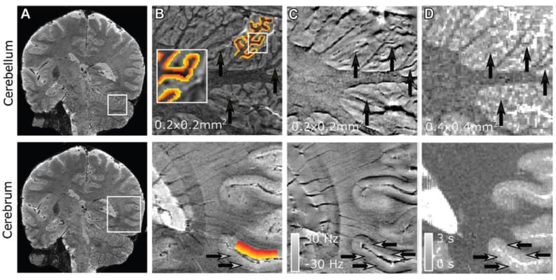 Ultrahigh-field MRI uncovers detailed structure of the brain’s ...