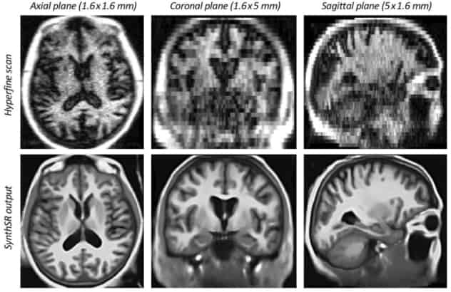 AI creates high-resolution brain images from low-field strength MR ...