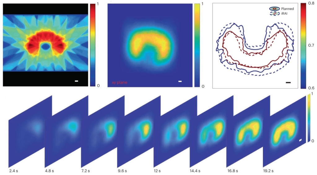 Dose tracking during radiotherapy could enable safer cancer treatments ...