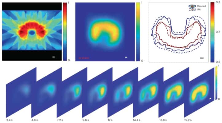 Dose tracking during radiotherapy could enable safer cancer treatments ...