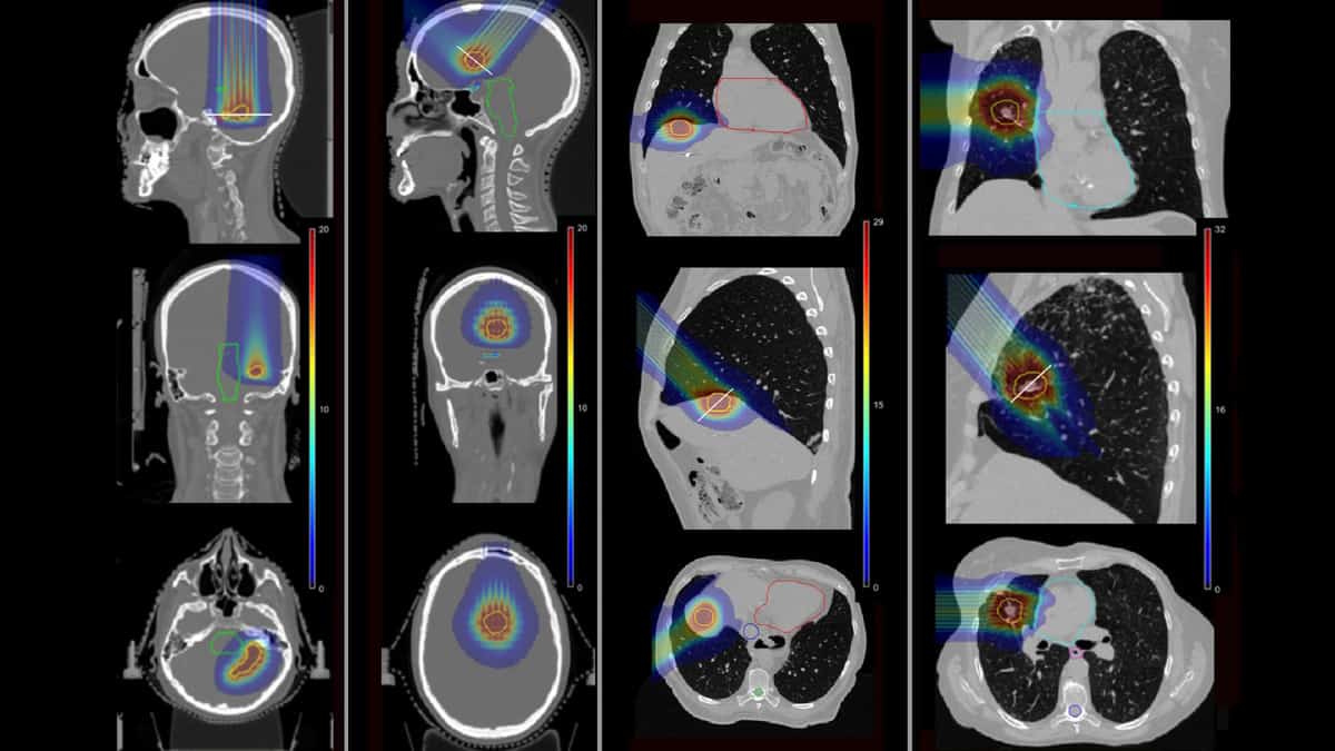 Proton minibeams could improve treatment of cancer metastases – Physics ...
