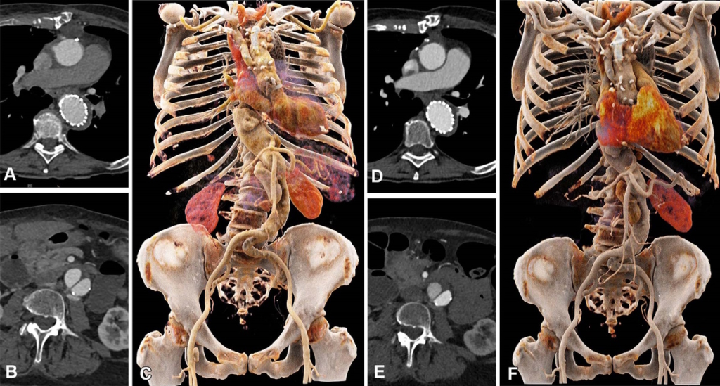Photon-counting CT improves cardiac imaging in infants with heart ...