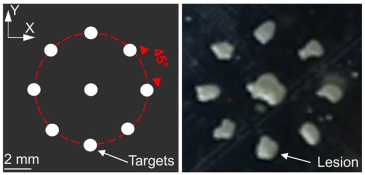 Image-guided HIFU system shows potential for clinical treatments ...