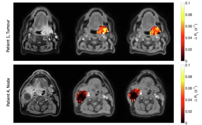 Towards combined hypoxia imaging and adaptive radiotherapy – Physics World
