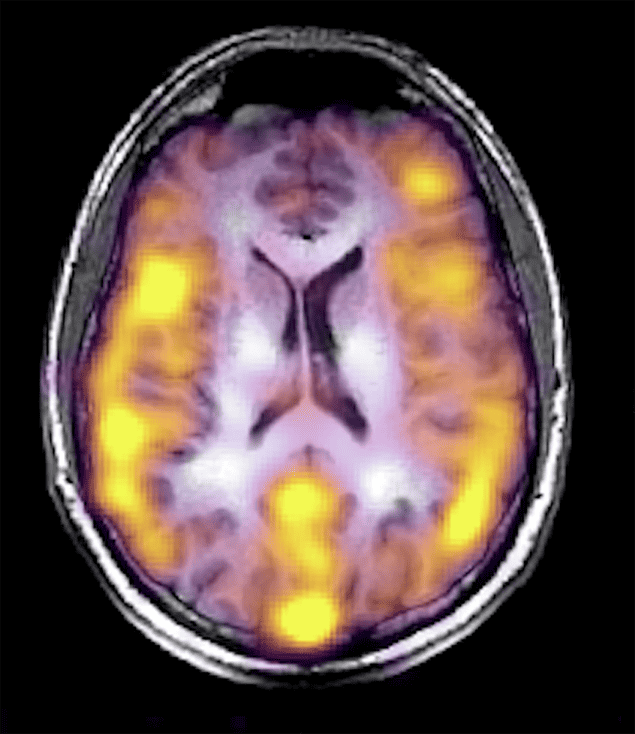 Dynamic Nuclear Polarization How A Technique From Particle Physics Is
