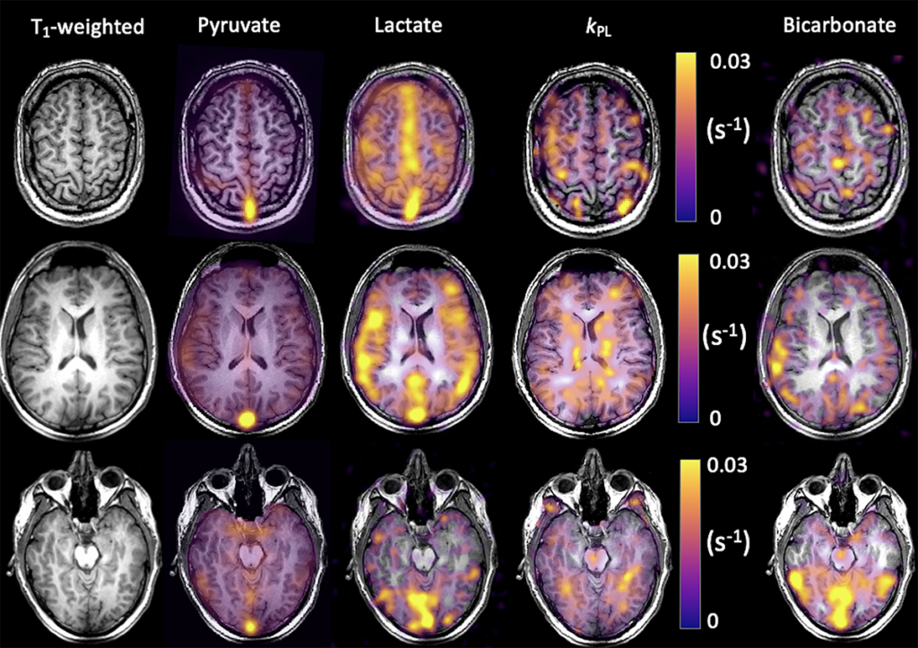 Dynamic nuclear polarization: how a technique from particle physics is ...