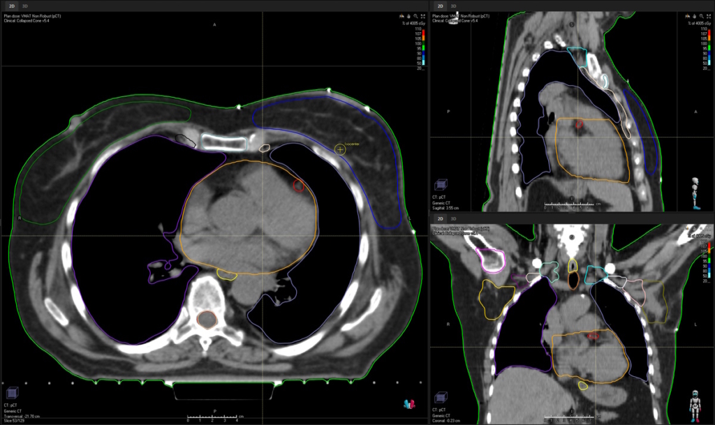 Machine-learning innovation in RayStation: prioritizing speed ...