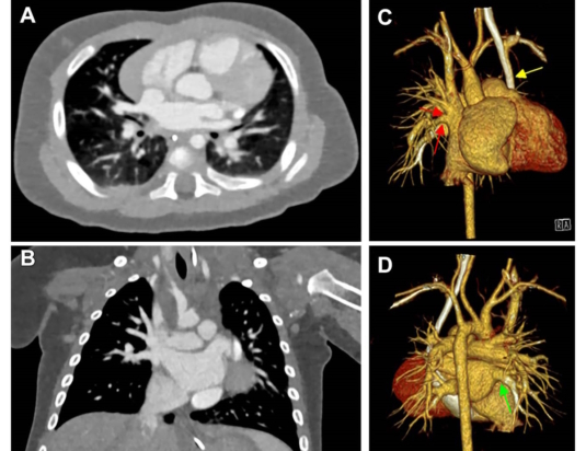 Photon-counting CT improves cardiac imaging in infants with heart ...