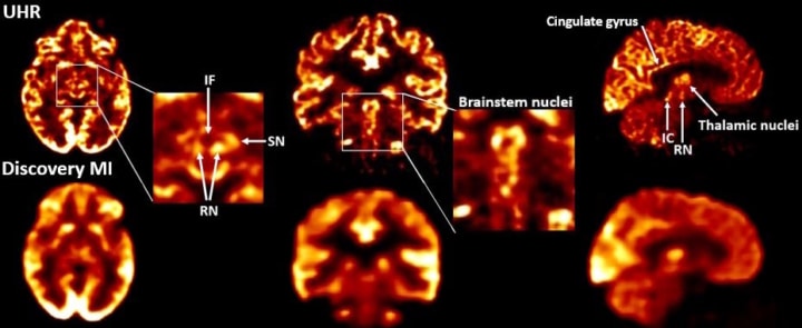Innovative devices ramp the resolution of PET imaging – Physics World