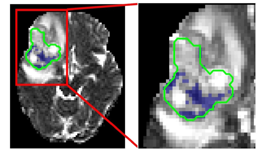 MRI-linac keeps track of brain tumour changes during radiotherapy ...